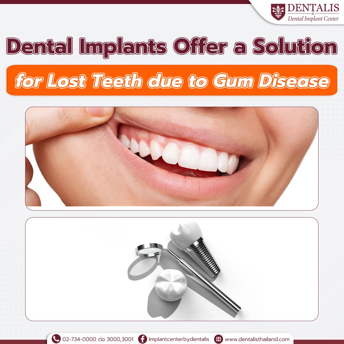 Dental Implants Offer a Solution for Lost Teeth due to Gum Disease ...