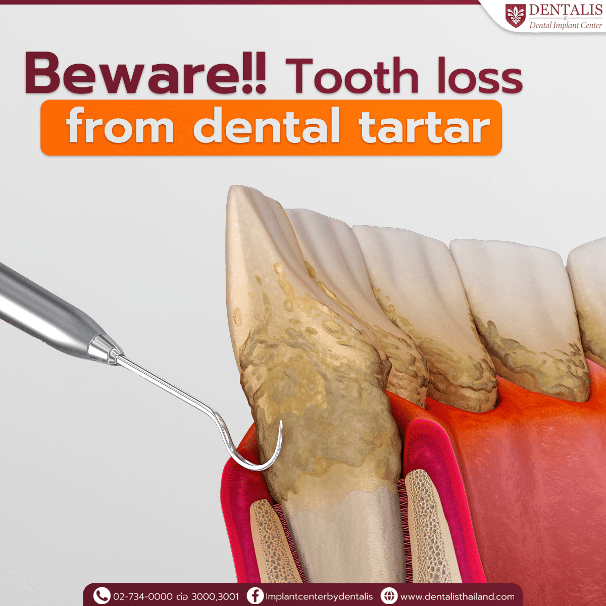 Beware!!! Tooth loss from dental tartar | Dentalis Thailand