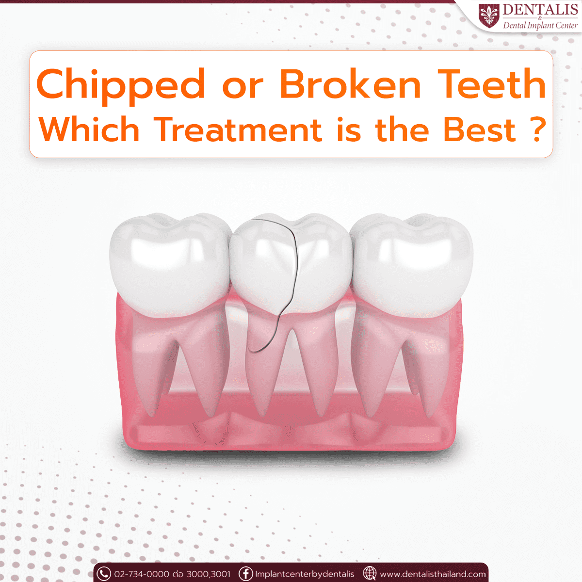 Chipped or Broken Teeth: Which Treatment is the Best? - Dentalisthailand