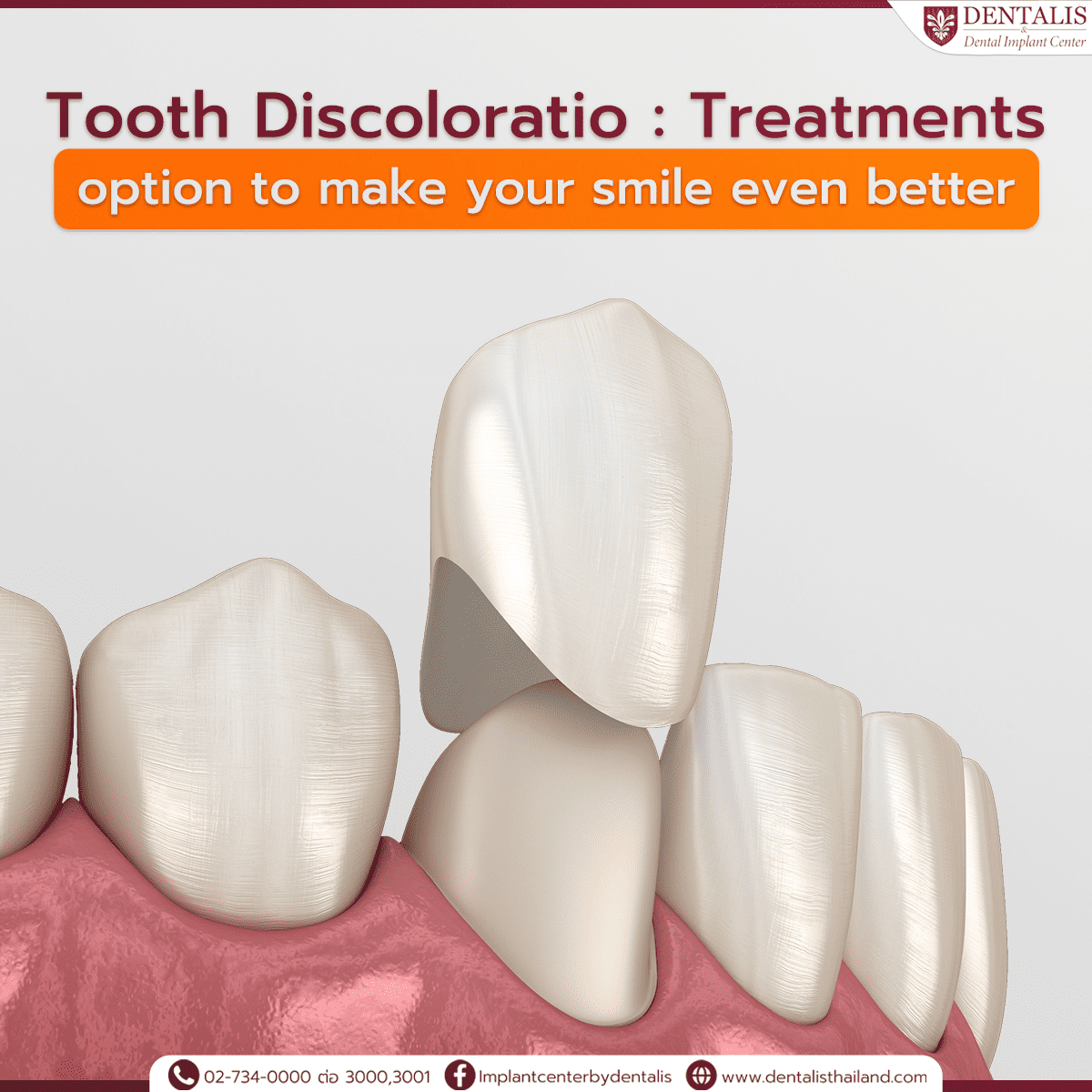 Tooth discoloration : Treatments option to make your smile even better ...
