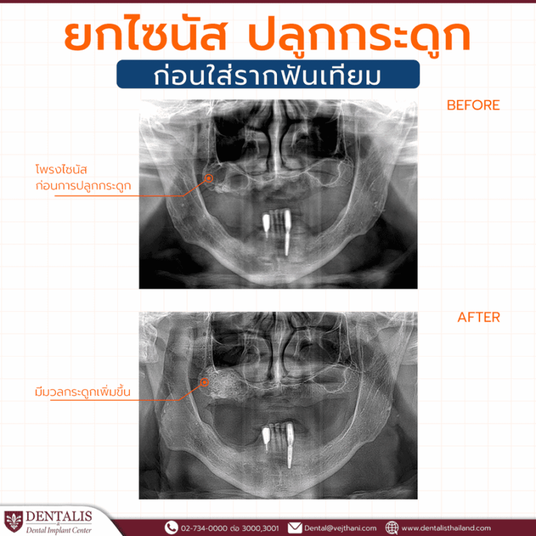 Maxillary sinus bone graft for dental Implants - Dentalisthailand