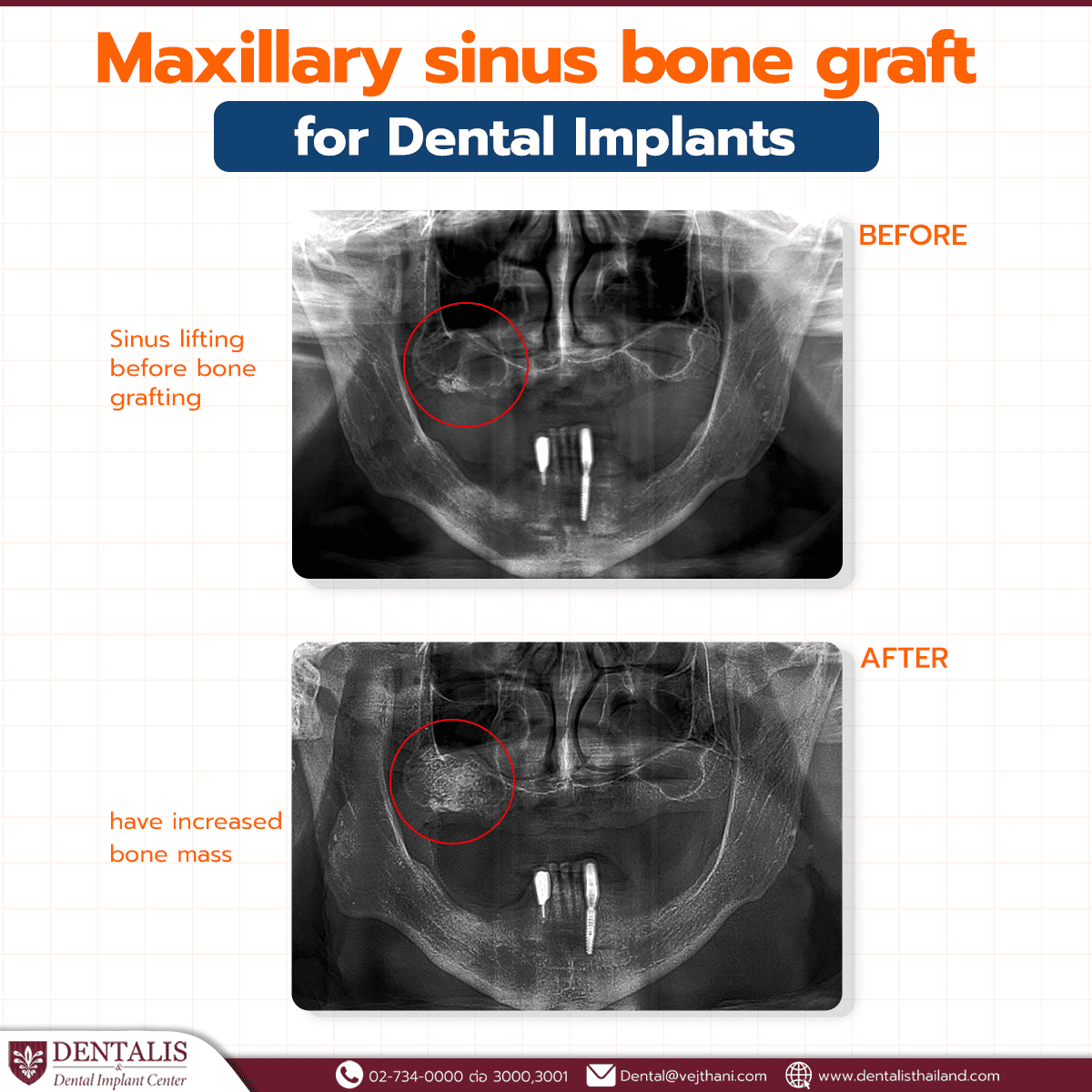 Maxillary sinus bone graft for dental Implants - Dentalisthailand