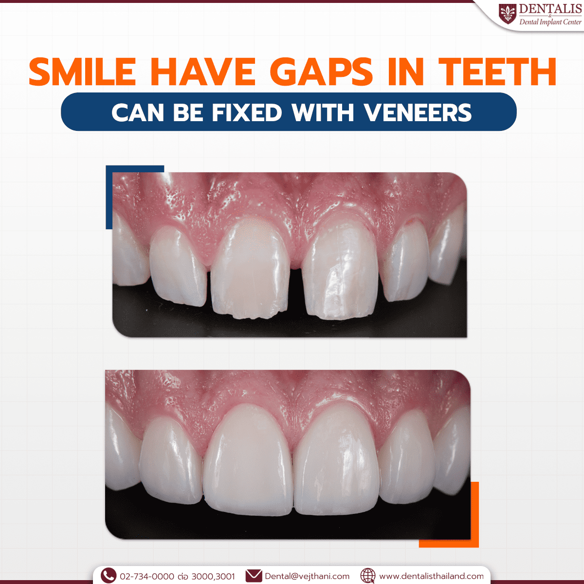 Smiling uncertainly Having problems with gaps in your teeth can be ...